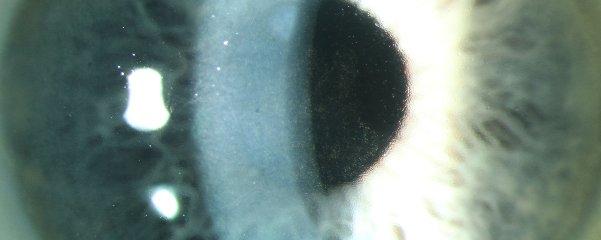 Fuchs corneal endothelial dystrophy