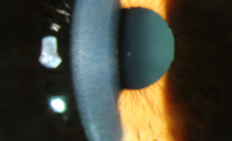 Fuchs corneal endothelial dystrophy