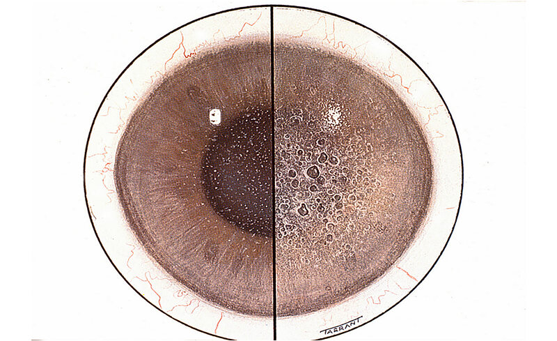 Fuchs corneal endothelial dystrophy