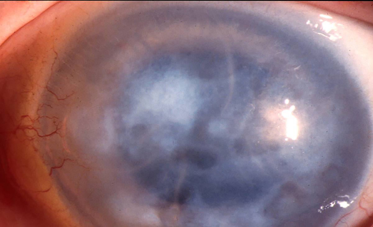 Fuchs corneal endothelial dystrophy